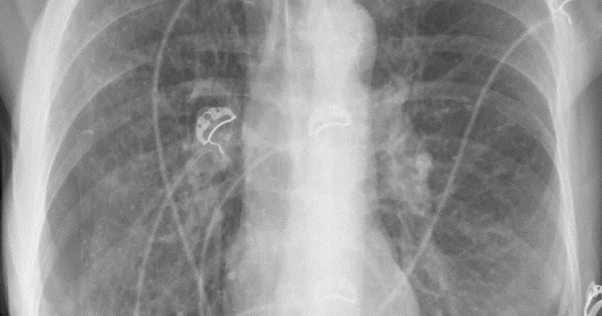 Een vrouw met acute dyspneu | NTVG