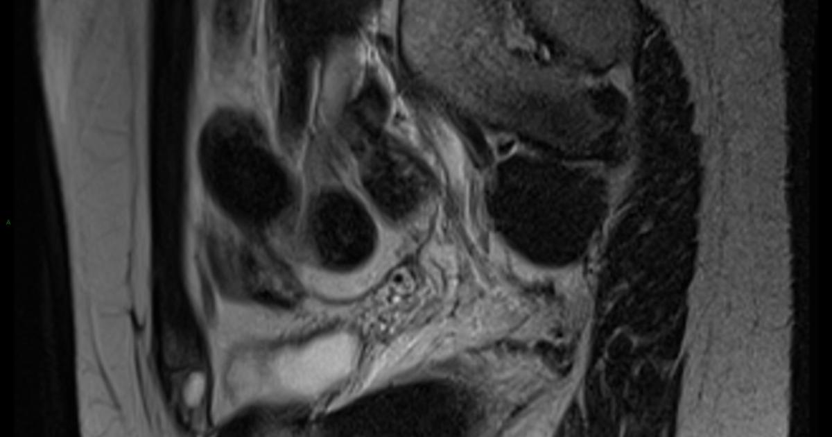 Een bijzondere oorzaak van chronische buikpijn | NTVG