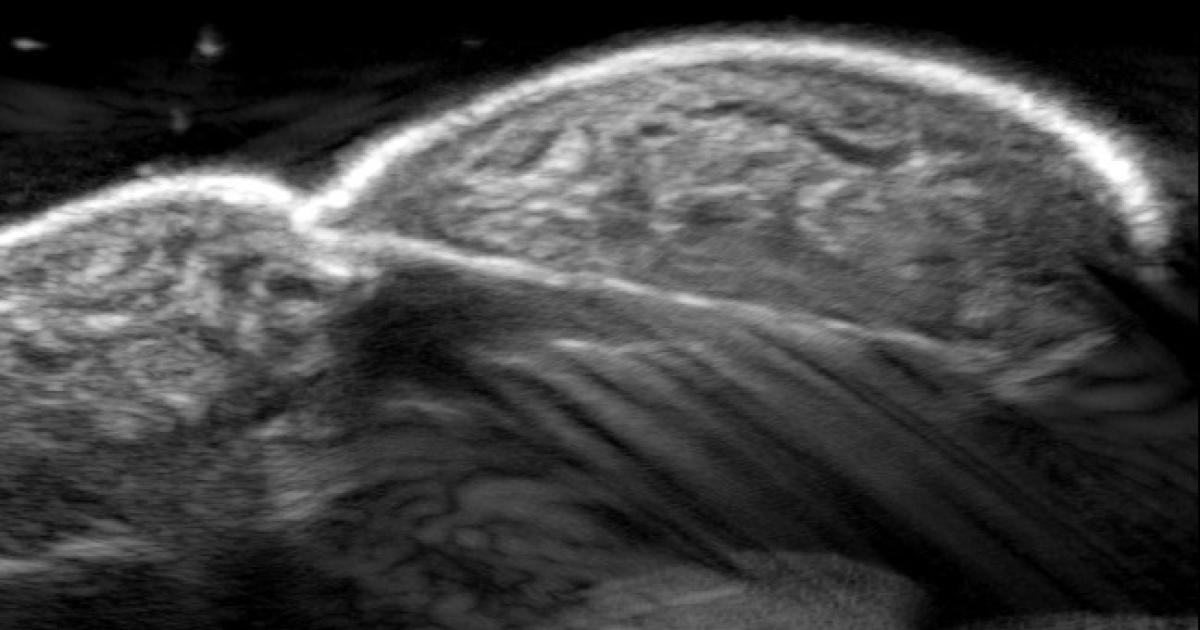 Een onzichtbare splinter in de vinger | NTVG