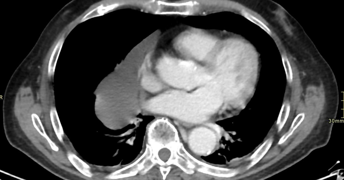 Een bolronde afwijking op de longfoto | NTVG