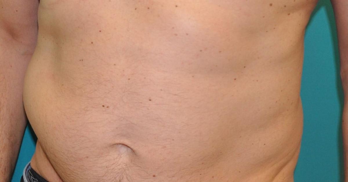 Een uitstulping van de buik | NTVG