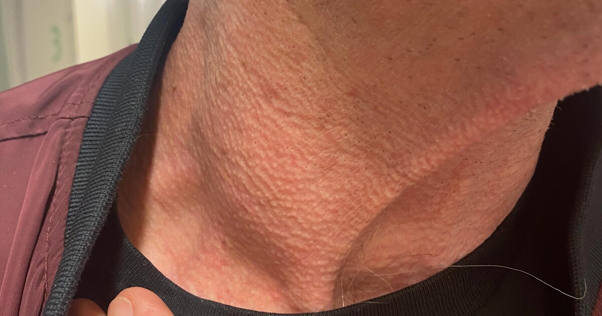 Een acute zwelling in de hals na coronaire angiografie | NTVG