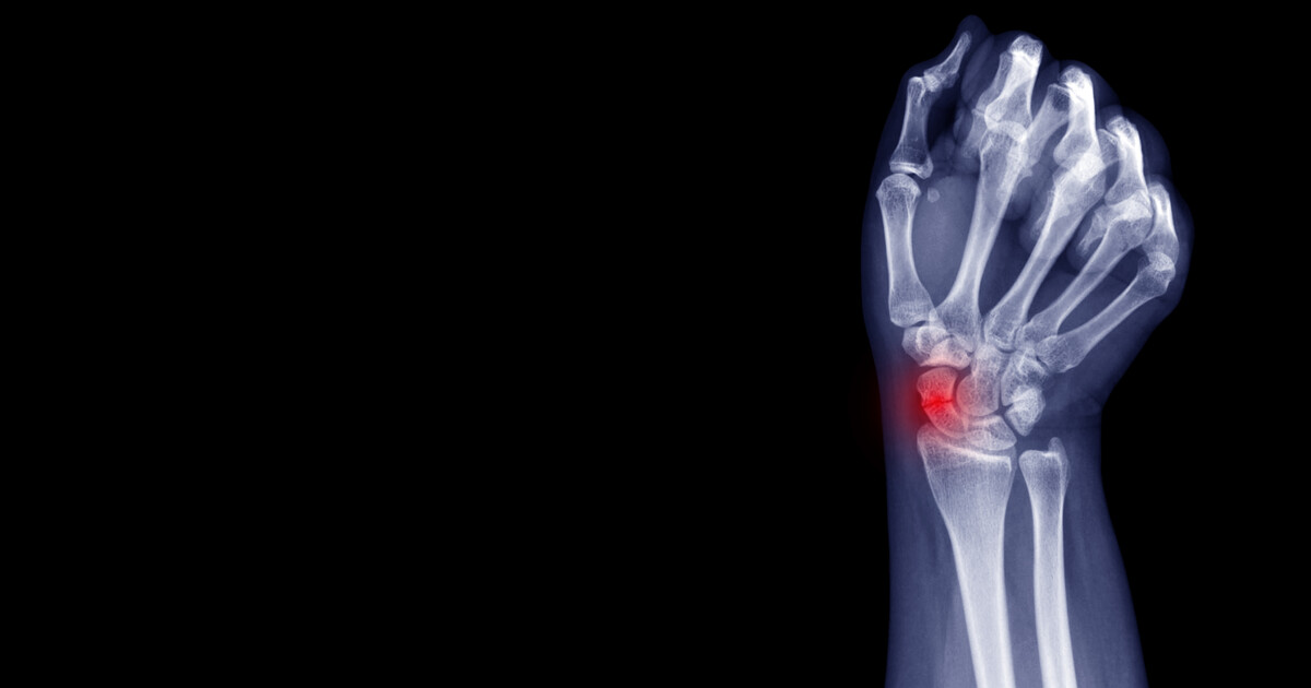 Drukverband bij verdenking scaphoïdfractuur | NTVG